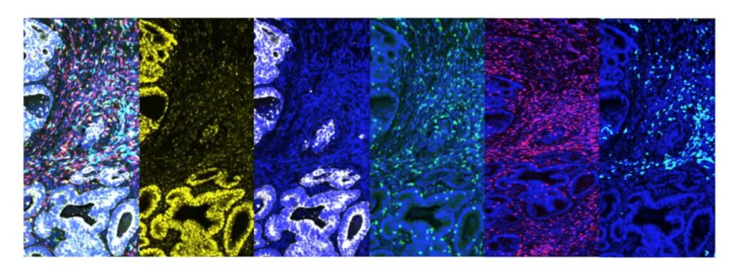 Biomarker Testing Consolidation and Implementation Using Multiplex ...