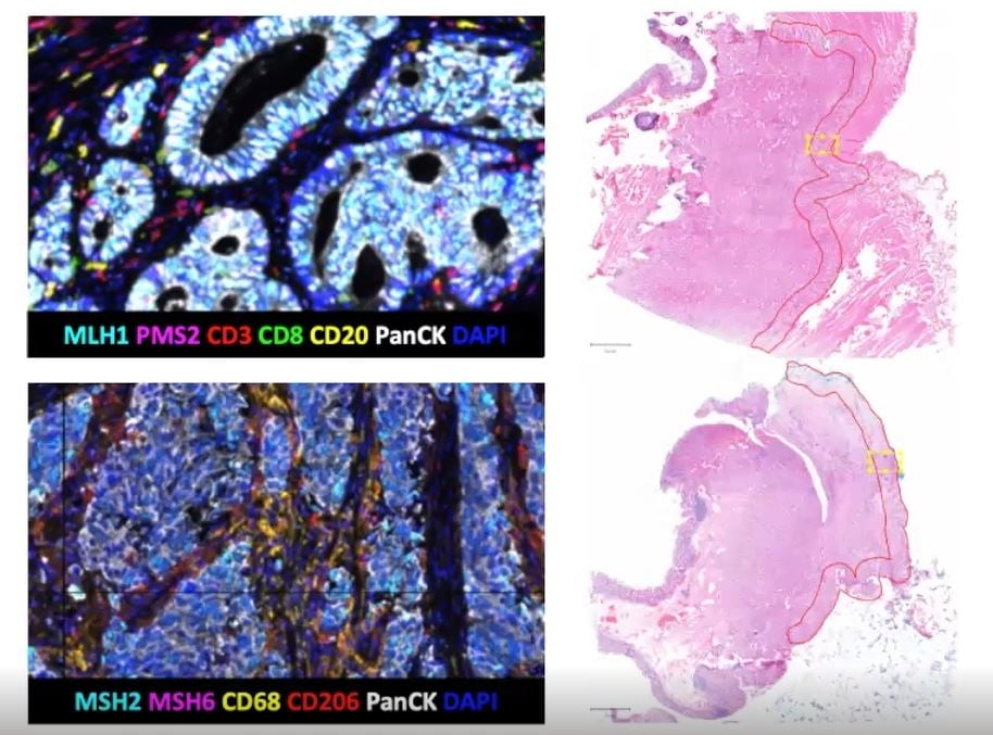 Biomarker Testing Consolidation and Implementation Using Multiplex ...