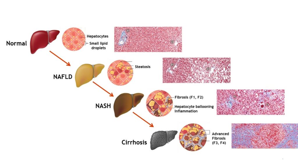 The Applicability of Clinical Biomarkers for NASH and Fibrosis